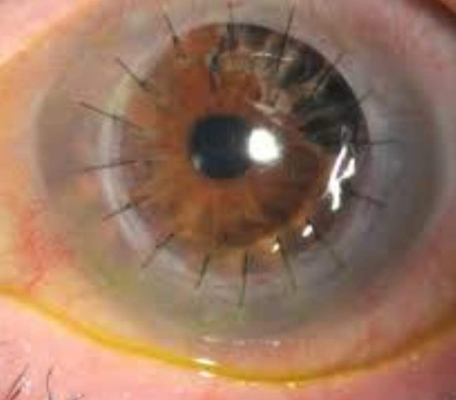 Realizan con éxito importante cirugía de trasplante de córnea