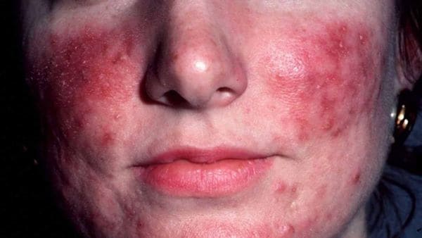 Piel gruesa, roja y con granos: qué es la Rosácea y cómo combatirla